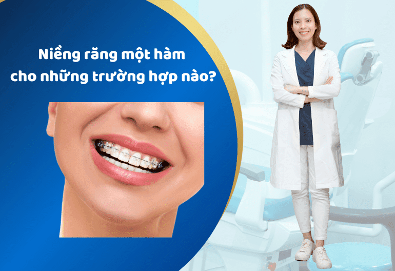 Niềng răng một hàm cho những trường hợp nào? - Nha Khoa 5S